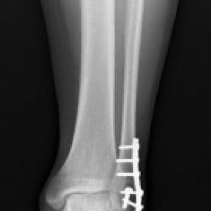 Fracture cheville opération Annecy, Cran-Gevrier