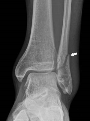 Fracture cheville opération Annecy, Cran-Gevrier